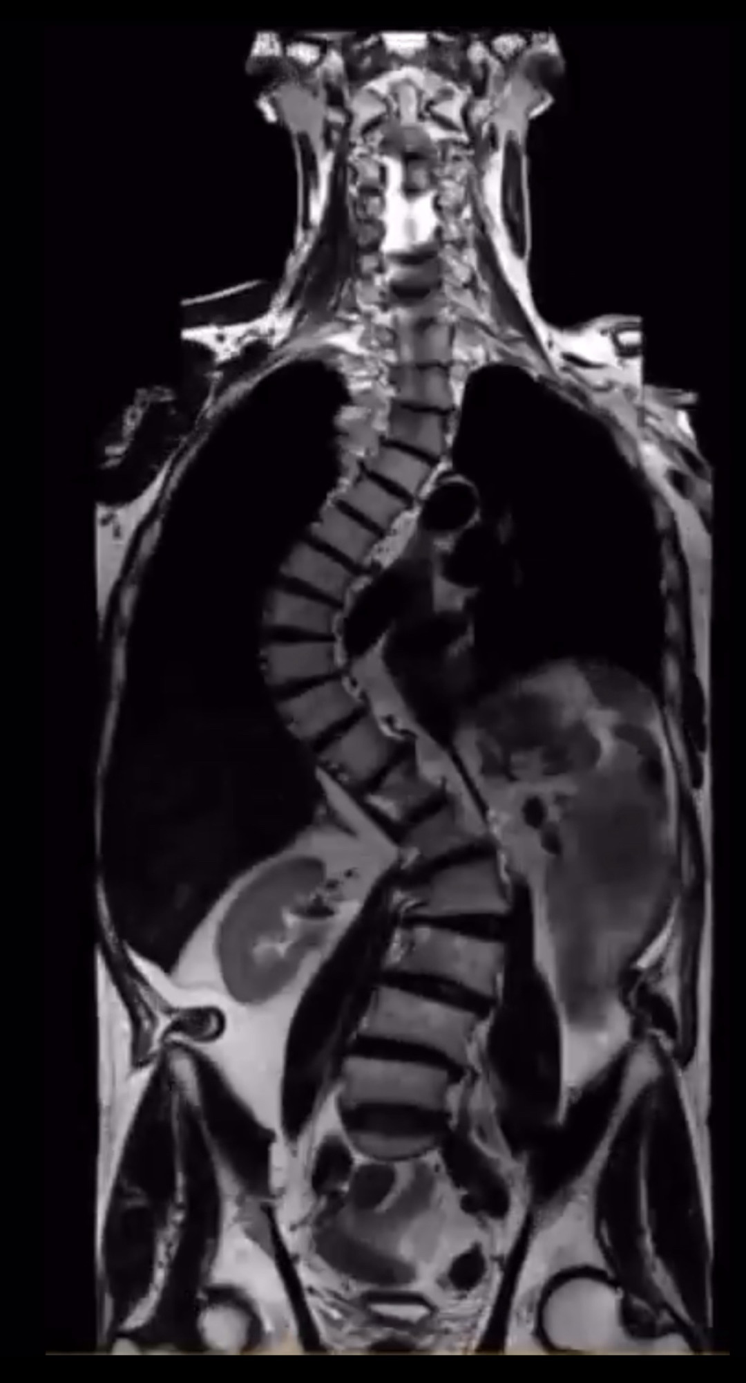Full Spine MRI (from neck to lower back ) in Dubai