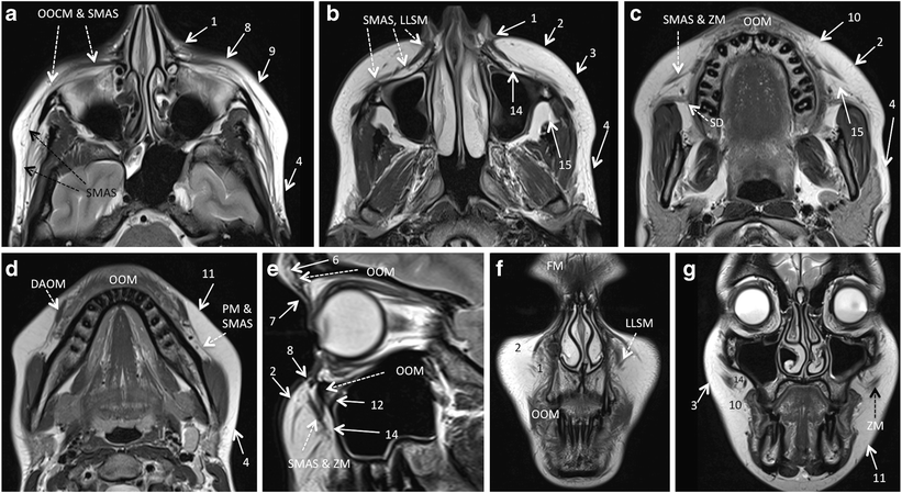 Filler MRI for face and butt in Dubai