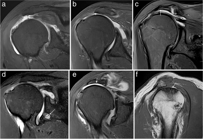 MRI Shoulder Dubai – Advanced 3 Tesla MRI for Precise Diagnosis