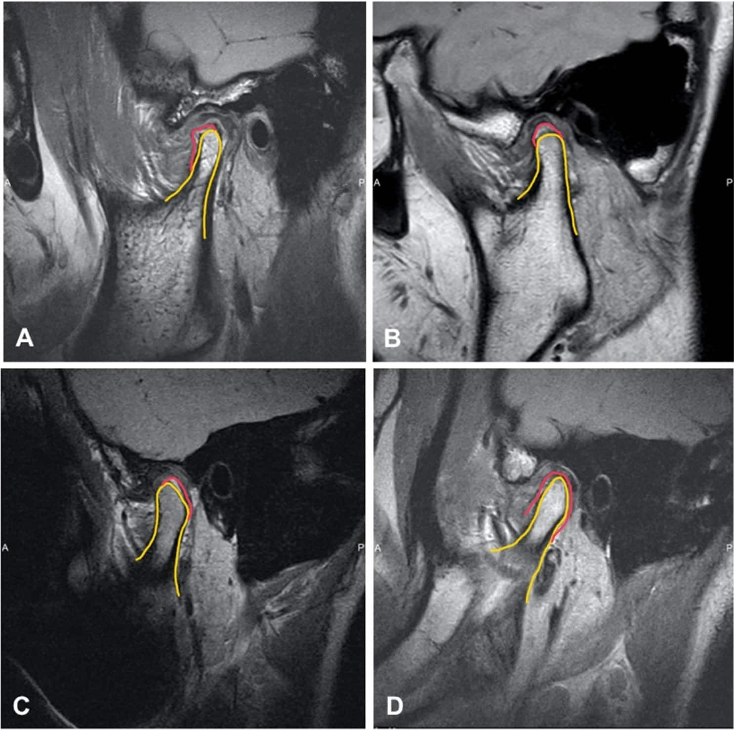 TMJ MRI: Essential for Jaw Pain Diagnosis